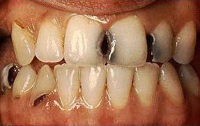 ODONTOLOGÍA MORFOFUNCIONAL: Caries dental