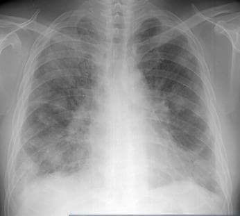 Chest Medicine Made Easy-Dr Deepu: Septic Pulmonary Embolism