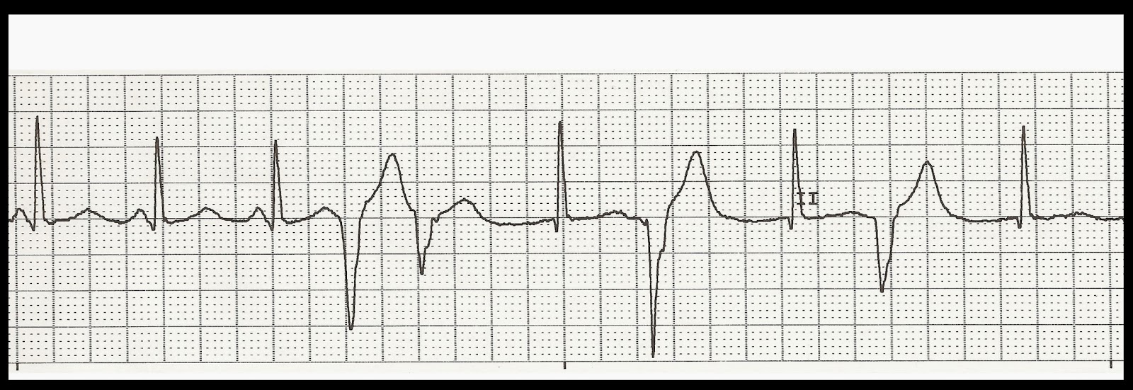 EKG Rhythm Strip Quiz 205