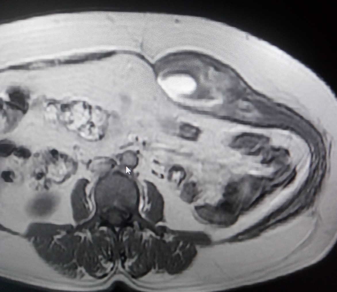 Abdominal wall mass –MRI Approach - Sumer's Radiology Blog