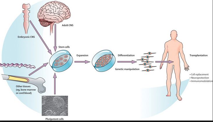 Neural transplantation of Parkinson's disease |Genetic Engineering Info