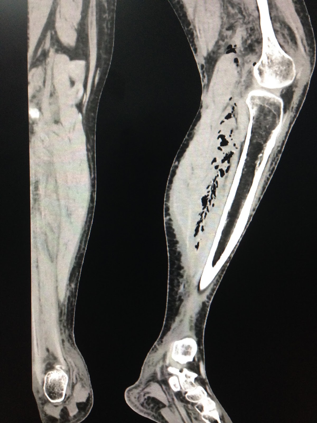 VIETNAMESE MEDIC ULTRASOUND: CASE 456 : LEG GAS GANGRENE, Dr PHAN THANH ...