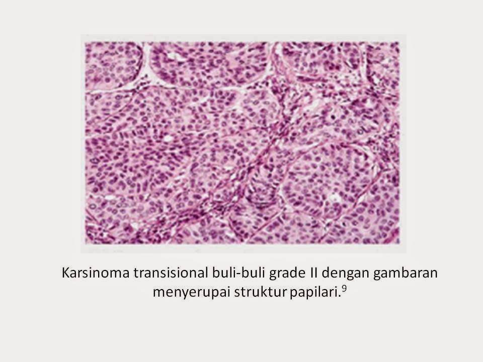 Reza Aditya Digambiro: KARSINOMA SEL TRANSISIONAL BULI BULI