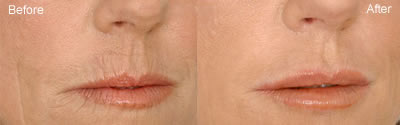 Selston Cosmetic Clinic: Lip Creases / Dermal Fillers - Nottingham ...