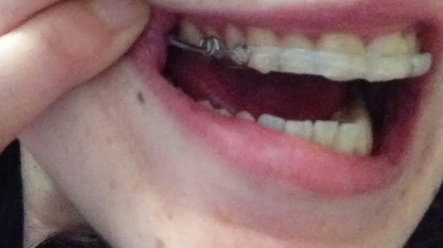 yayalicemay: Inman Aligner