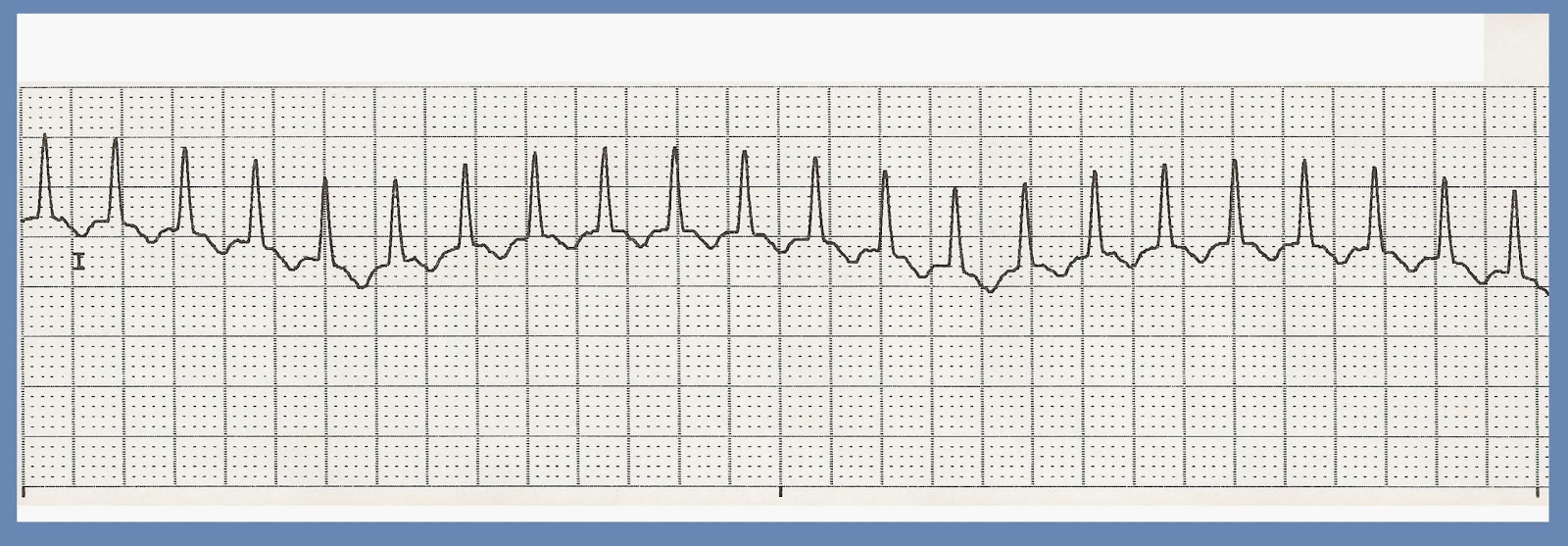 EKG Rhythm Strip Quiz 199