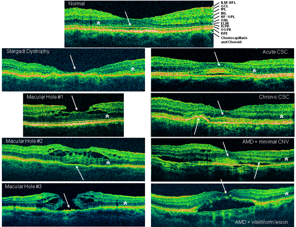DEGENERACION MACULAR : DMAE SECA. OCT DE CONTROL