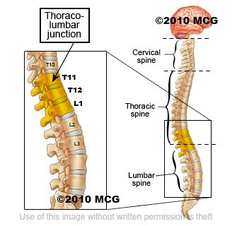 TRAIN OUT PAIN: Stabilizing the Thoraco-Lumbar Junction
