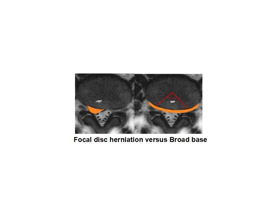 Wessam Bou-Assaly: Wessam Bou-Assaly: Disc Disease and Radiology