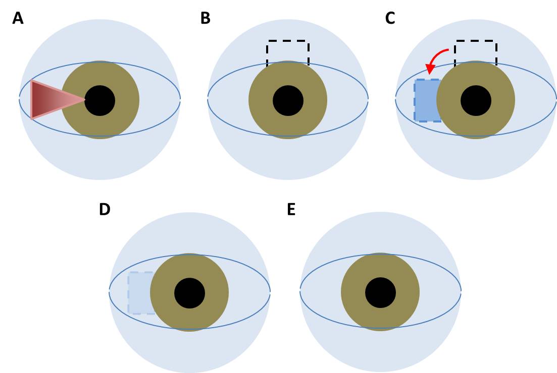 Pterigión: causas y tratamiento
