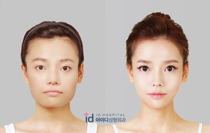 ID Hospital Korea: [cosmetic surgery korea review] facial contouring ...
