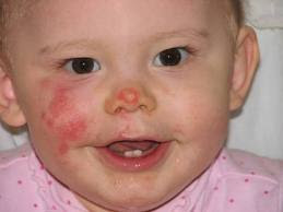 Health Pictures: impetigo in children