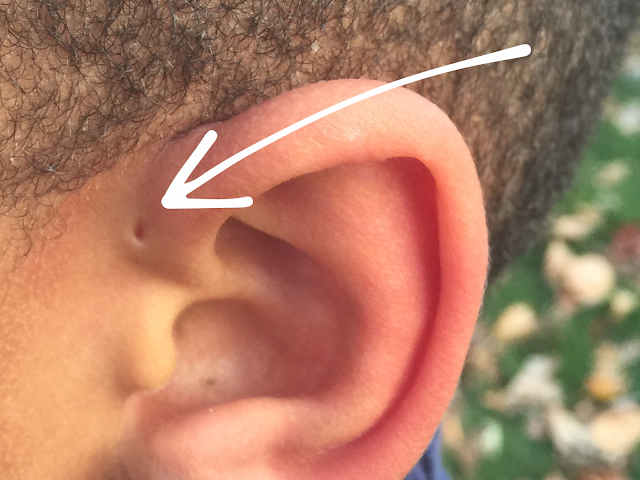 Here's why some people have a tiny hole above their ears - H.D.N
