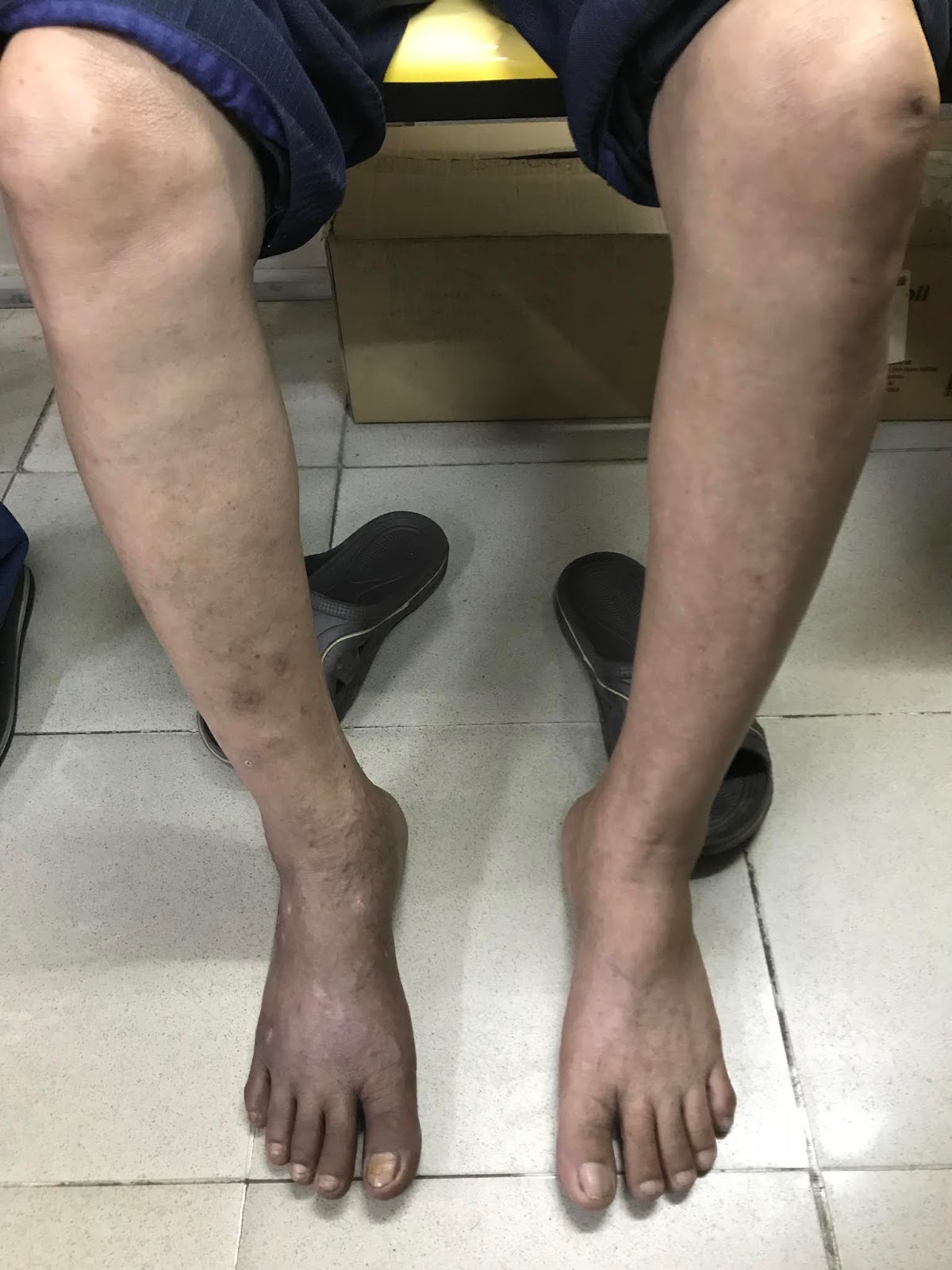 VIETNAMESE MEDIC ULTRASOUND: CASE 505: LEG ISCHEMIA, Dr PHAN THANH HẢI ...