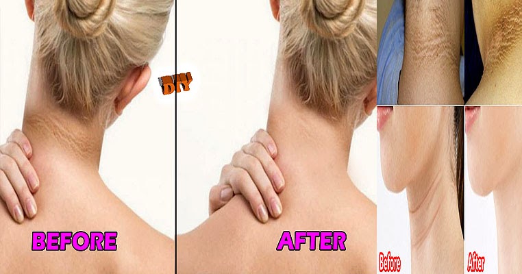 How To Get Rid of Dark Neck in 15 Minutes at home Fast and Quickly ...