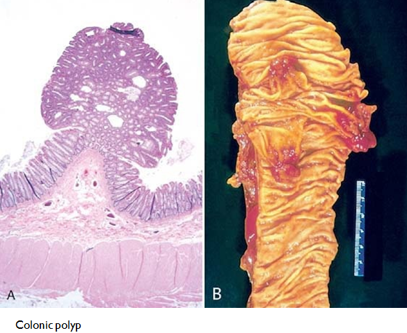 MBBS Medicine (Humanity First): Neoplasia