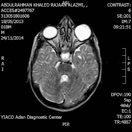 Radiology Channel: Anatomy of bundles of ACL and PCL.