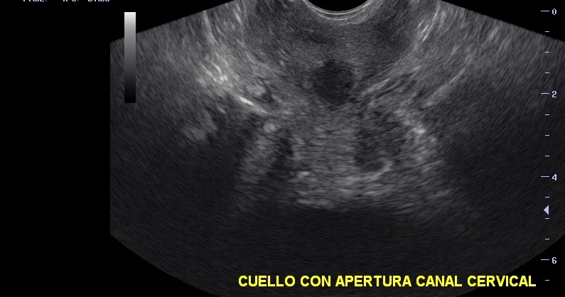 Incompetencia Cervical