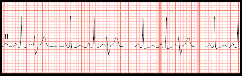 Various Trigeminal PVCs
