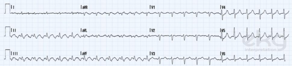 Atrial Flutter (Fluter Atrial) - JANTUNG OKE