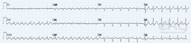 Atrial Flutter (Fluter Atrial) - JANTUNG OKE