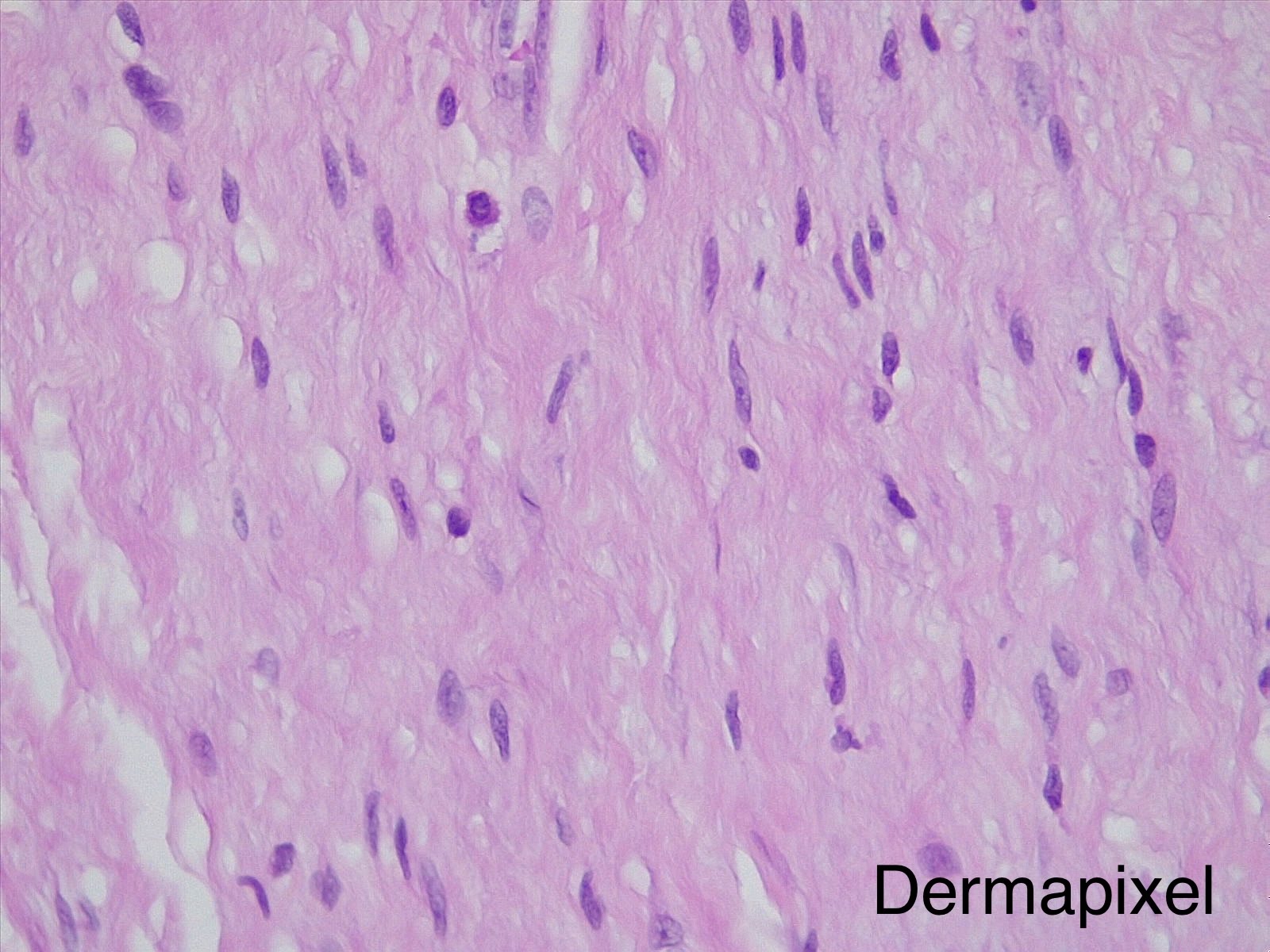 Dermapixel: El neurofibroma solitario
