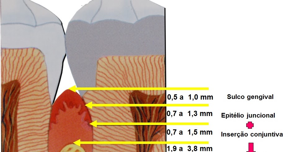Saúde da Boca: Preparo Cavitários- CAVIDADES CLASSE I e II PARA AMÁLGAMA