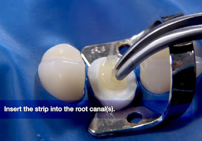 PROSTHODONTICS: Dentapreg Anatomical Post - Odonto-Tv
