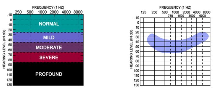 OK chicoesperto: O que é um audiograma? Como ler um audiograma.