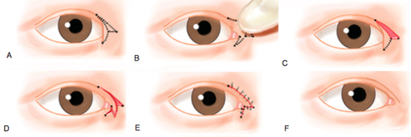 Eyelid Surgery by Prof Dr CN CHUA 蔡鐘能: February 2016