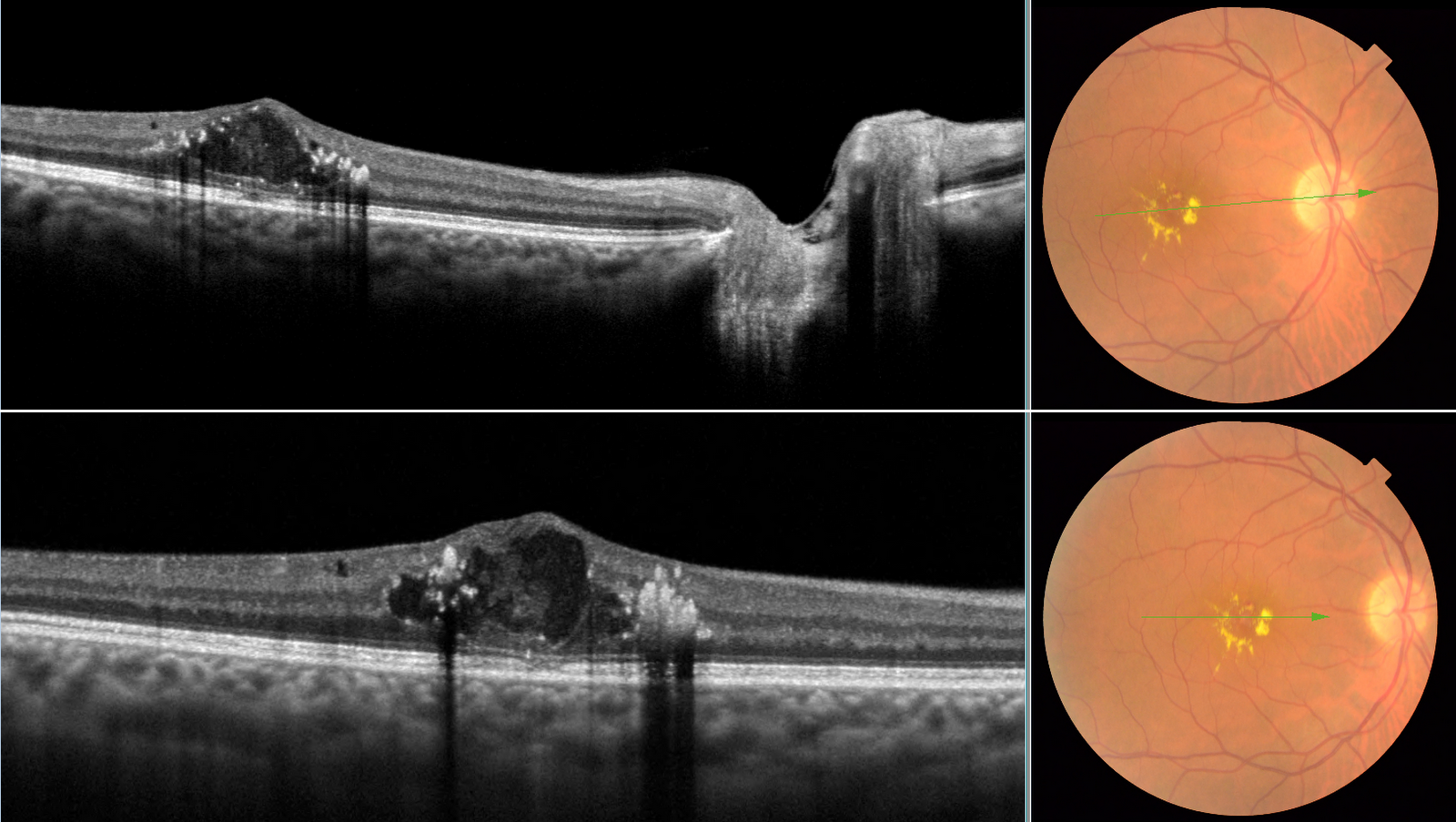 Tomografía de Coherencia Óptica