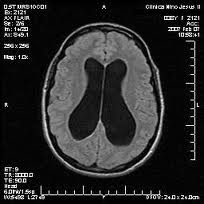 Hidrocefalia