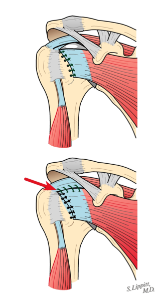 UW Shoulder and Elbow Academy: The ream and run in the face of severe ...