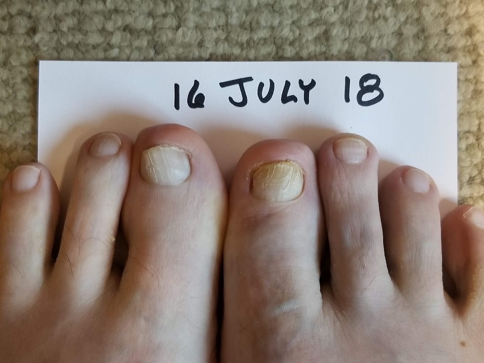 Run with Perseverance: A Tale of Two Toenails; How to Fix Runner's Toenails