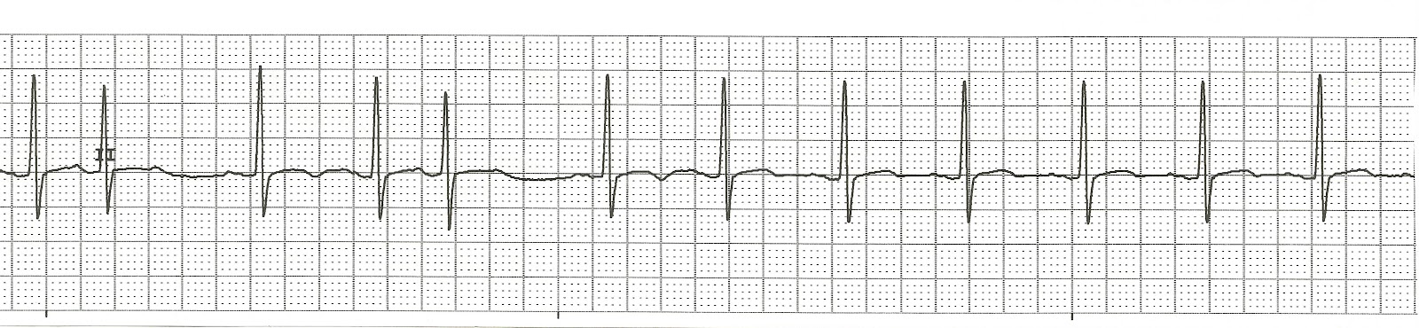 EKG Rhythm Strip Quiz 72