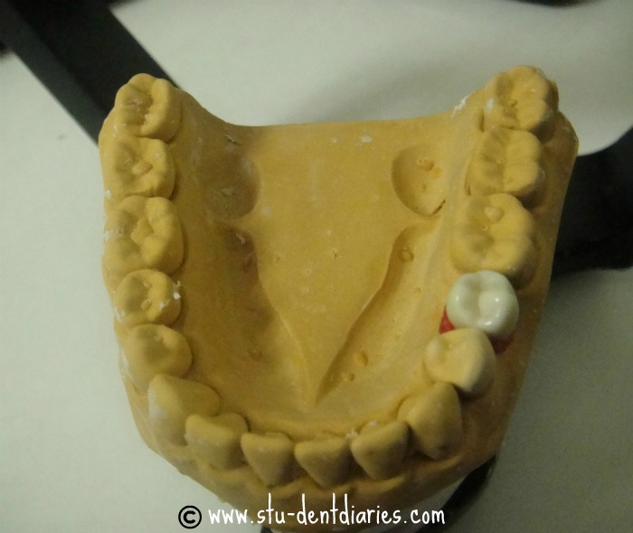 Stu-DENT Diaries: The Making of a Three Unit Bridge 1