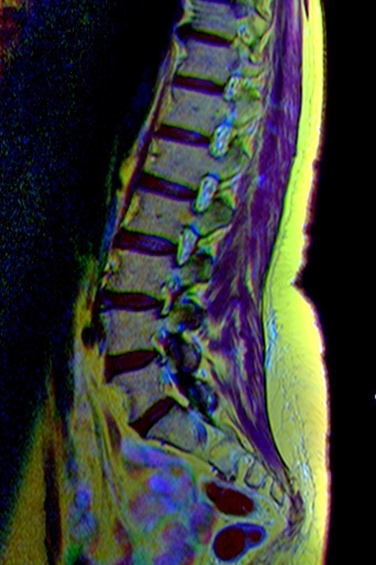Nevit's blog: Color MRI of spine