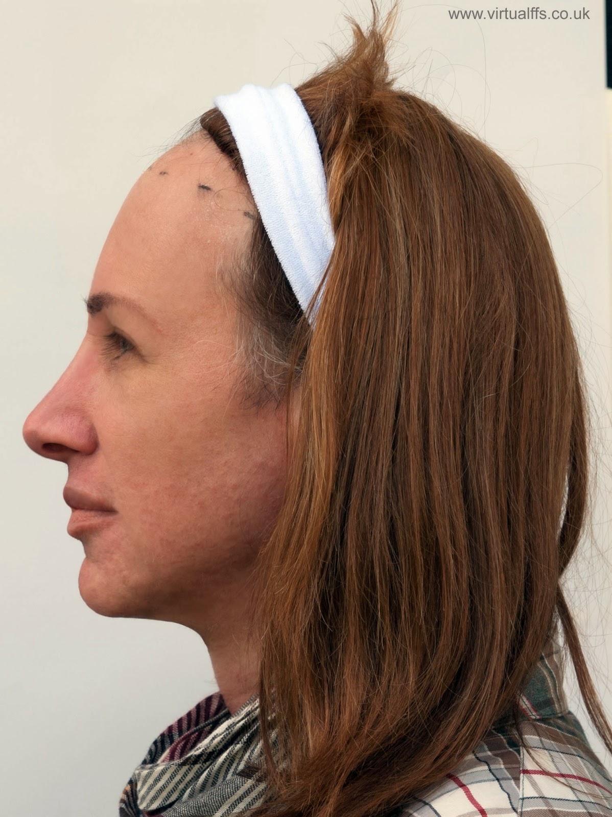 Sandras Weg: 48 Stunden post OP: Die ersten Bilder