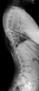 Shilla Growth Guidance Procedure | Growing Spine Blog | Washington ...