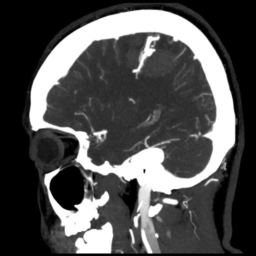 Post Gad: Small AVM with Large ICH