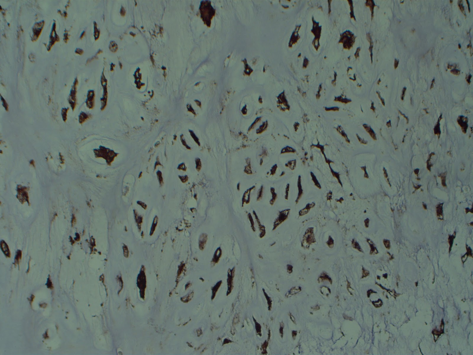 dr pankaj goel: Chondrosarcoma of the Sternum- Radical Excision and ...