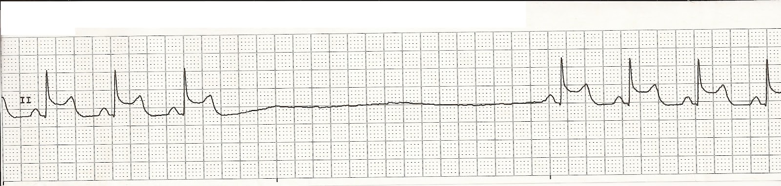 EkG Rhythm Strip Quiz 16