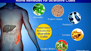How To Stop Ulcerative Colitis Bleeding - Ulcer Choices