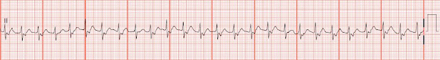 EKG Rhythm Strip Quiz 6