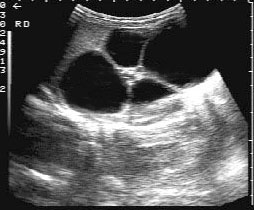 ecografie imagini medicina renal Renal nativ Hidronefroza | Terapii ...