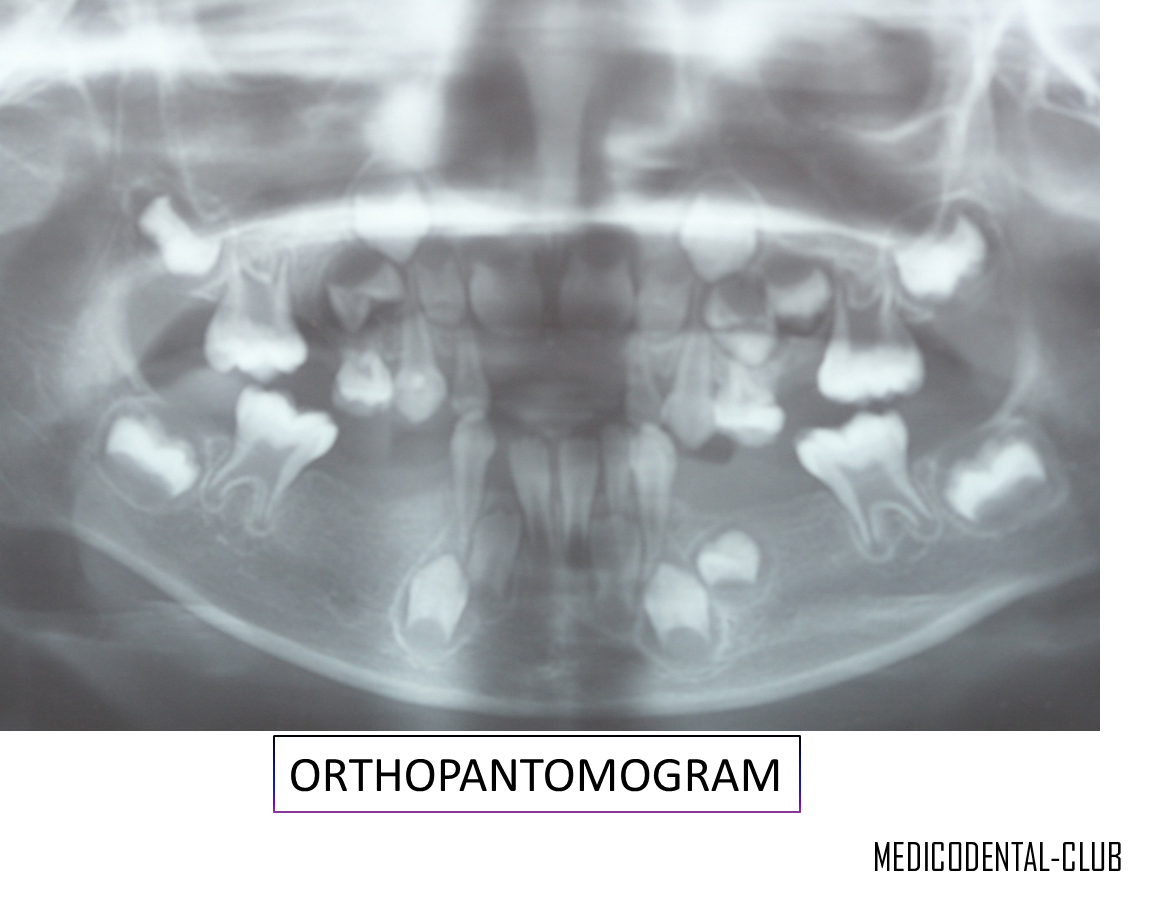 MEDICODENTAL: PIC 1: OPG / CONGENITALLY MISSING TEETH