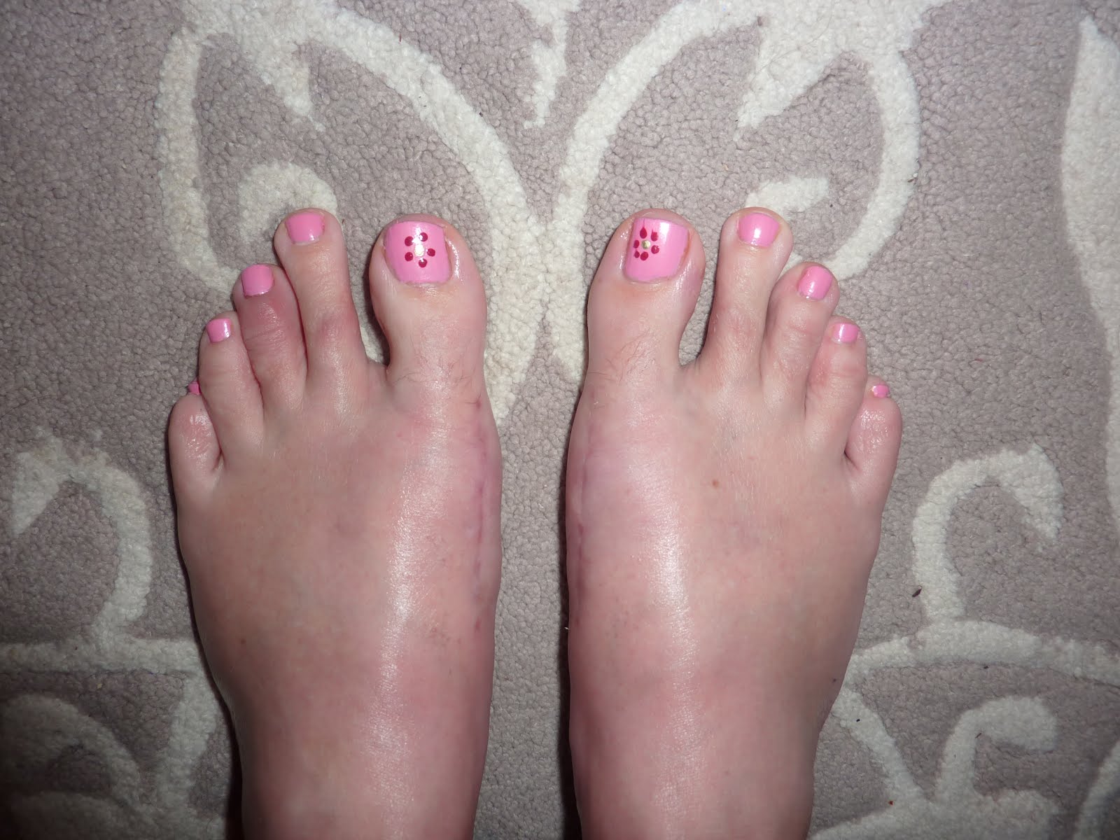 From bunions to beautiful feet: Toe spacers and pedicures