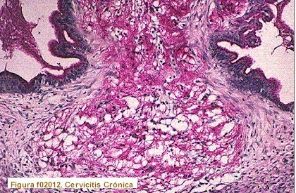 Agustina Ocampo - Patología B 2014: Cervicitis aguda y crónica