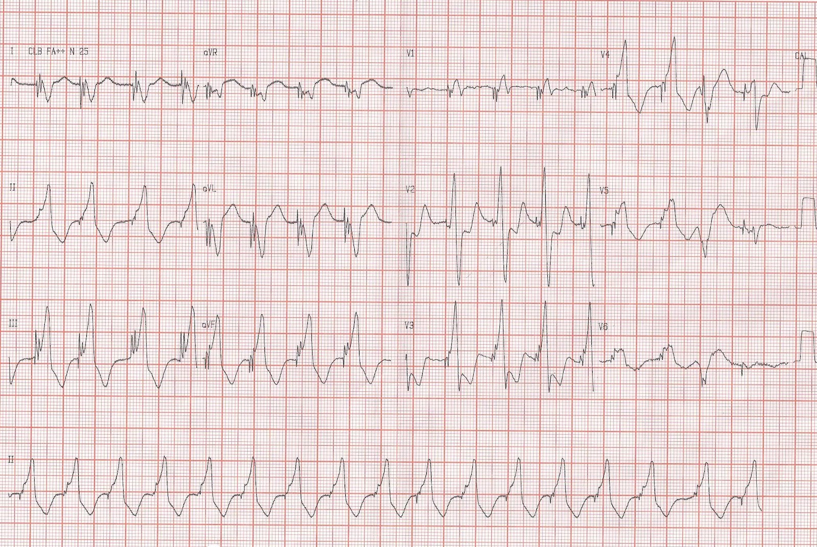Blog de Eletrocardiografia: Março 2012