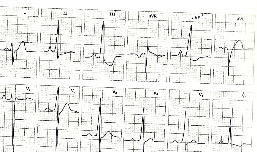 Electrocardiograma: Caso clínico 'Eje eléctrico'